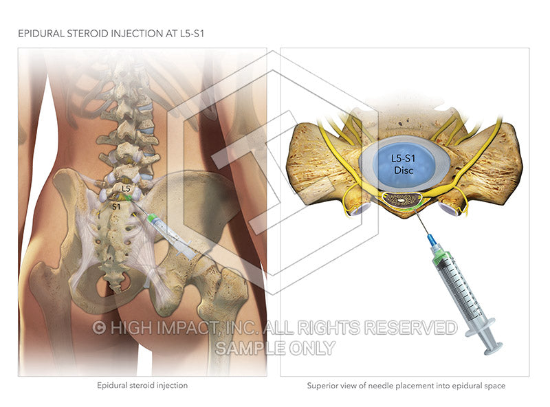 Image 11652: Epidural Steroid Injections at L5-S1 Illustration