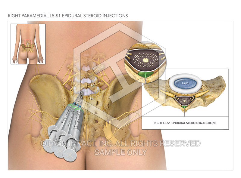 Epidural Steroid Injection L5 S1 0158