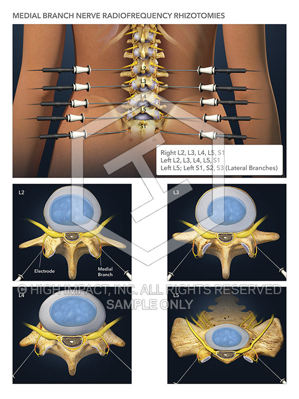 Image 08298_im01: Medial Branch Nerve Radiofrequency Rhizotomies Illus