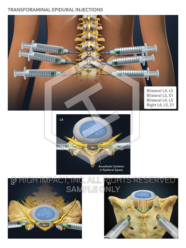 Image 08298_im03: Transforaminal Epidural Injections Illustration ...