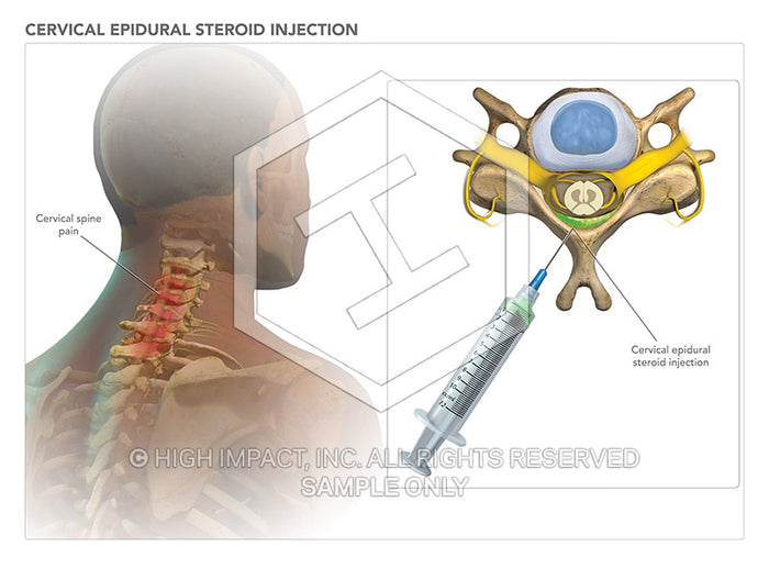 Image 08435: Cervical Epidural Steroid Injection