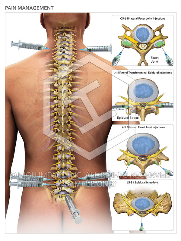 Image 08627: Spinal Pain Management Injections Illustration