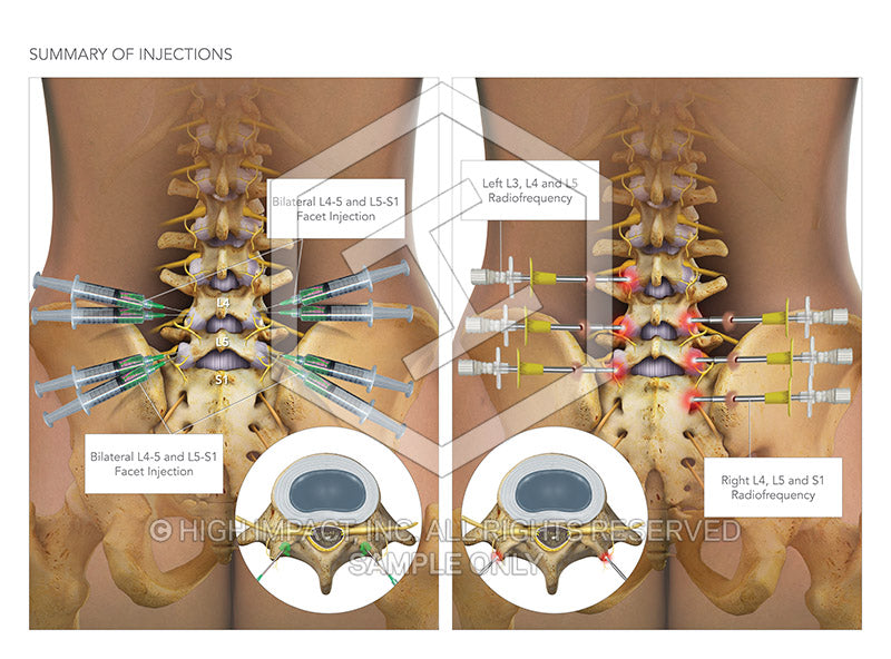 Image 08876: Lumbar Pain Management Injections Illustration – Trial Guides