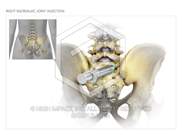 Sacroiliac Joint Injection