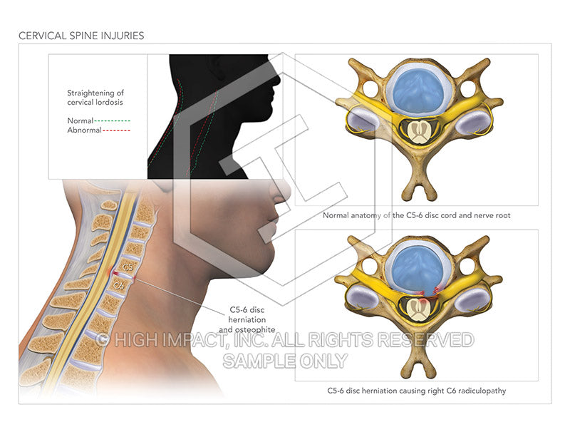 Straightening Of Normal Cervical Lordosis