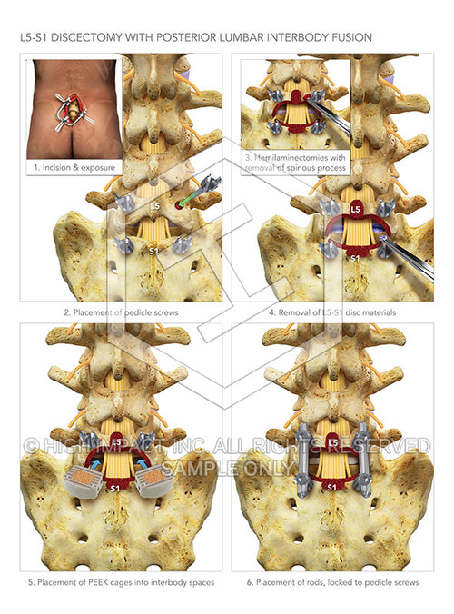 Image 10363_im03: L5 Discectomies with Posterior Lumbar Interbody Fusi