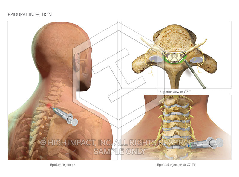 Image 10568_im01: Cervical Epidural Injections Illustration