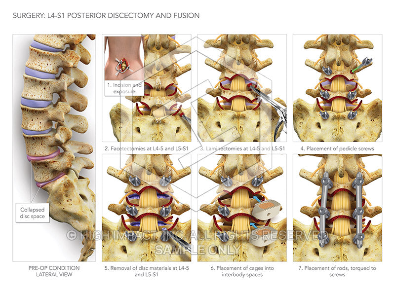 Image 10740: L4-S1 Posterior Discectomy with Fusion Surgery at L4-S1 I ...