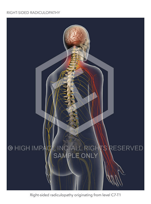 Image 11928: Cervical Radiculopathy Illustration