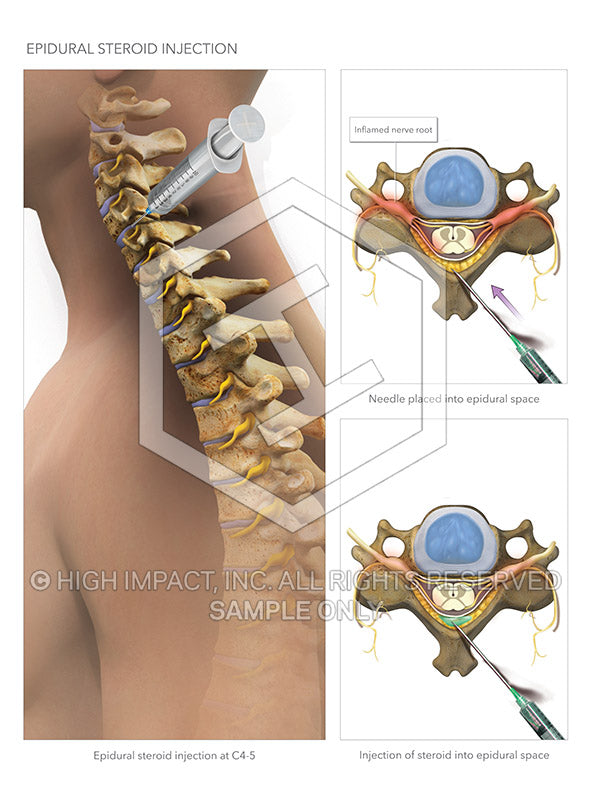 Image 12352: Cervical Epidural Steroid Injection Illustration