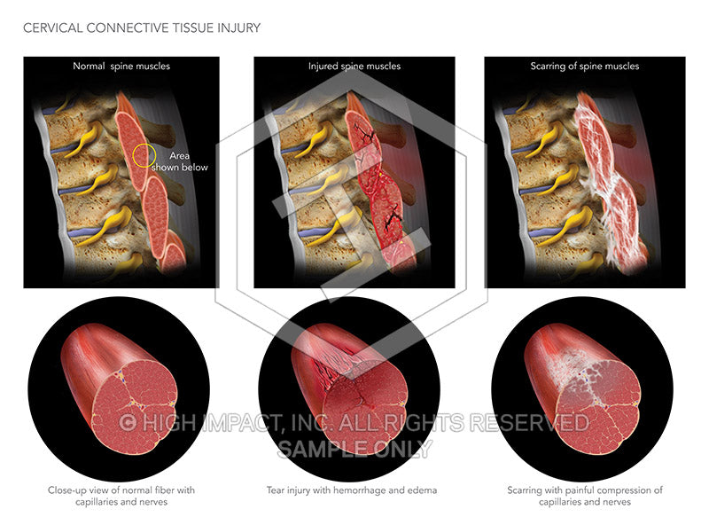 Image 12627: Cervical Connective Tissue Injury Illustration