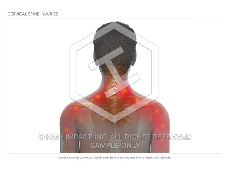Image 12889: Bilateral Cervical Radiculopathy (radiating pain in the a ...