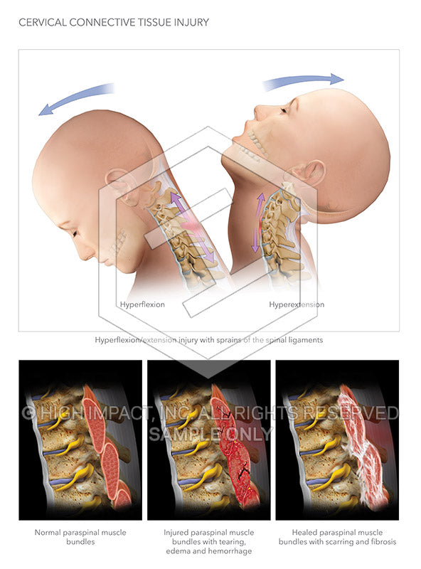 Image 13058: Cervical Connective Tissue Injury Illustration