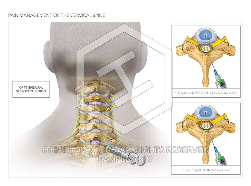 Image 18938: Cervical Epidural Steroid Injection